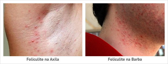 FOLICULITE - Ciência da Pele