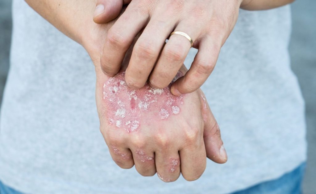 Psoríase pustulosa - Dr. lista 5 causas e a solução
