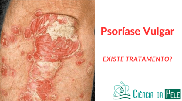 Confira os 3 melhores tratamentos para Psoríase no Rosto